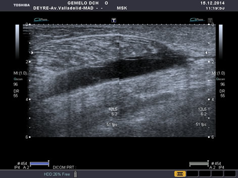Caso clínico: Rotura del gemelo interno | Centro Médico Deyre